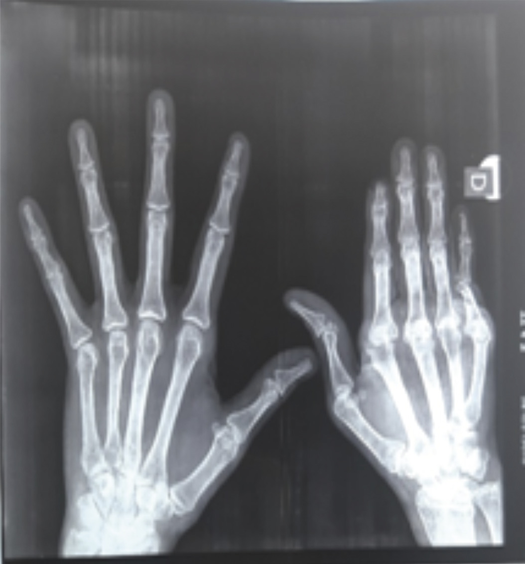 Polyarthrite rhumatoïde unilatérale de la main | La Revue du Praticien