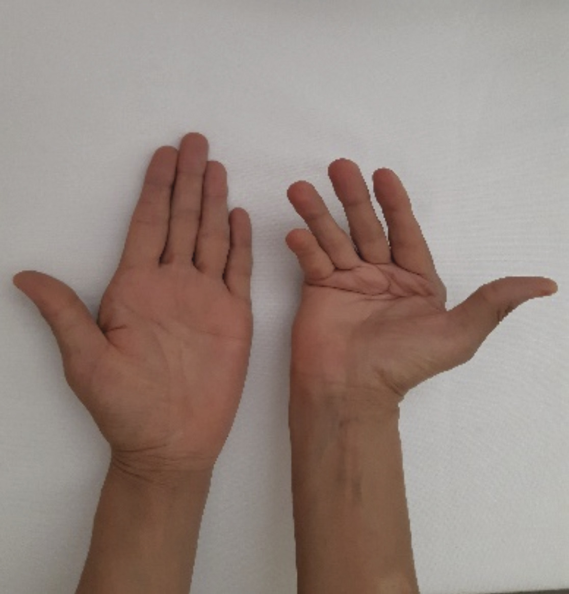 Polyarthrite rhumatoïde unilatérale de la main | La Revue du Praticien