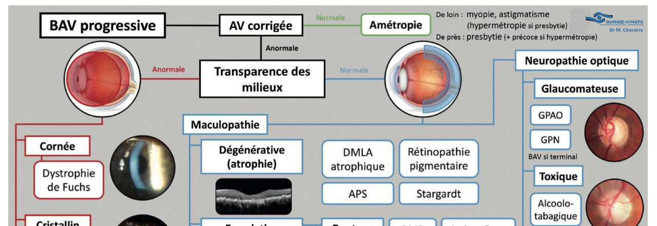 Orientation diagnostique devant une baisse d’acuité visuelle ... Orientation diagnostique devant une baisse d’acuité visuelle ...