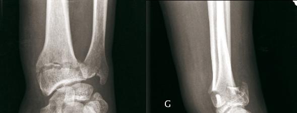 Fracture de Gérard Marchand | La Revue du Praticien